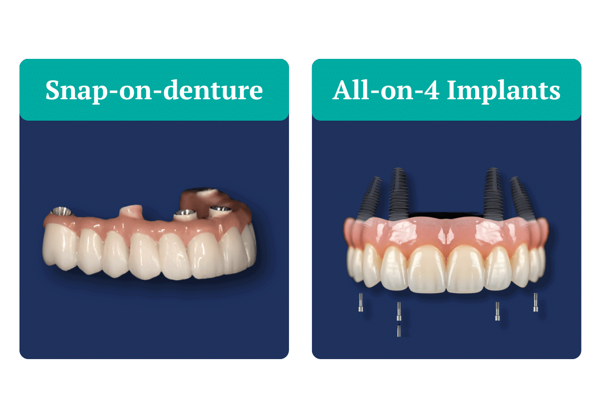 Dentures vs Implants: Which One is Right for Me? - Suave Dental Clinic