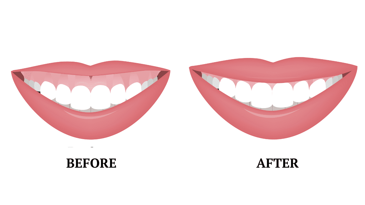 What Is A Gummy Smile And What Is Its Treatment Options?