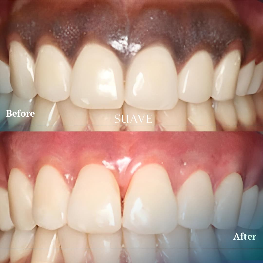 Gum Bleaching and Depigmentation : How To Make Gums Pink