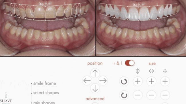 Digital Smile Design For a Perfect Smile Makeover