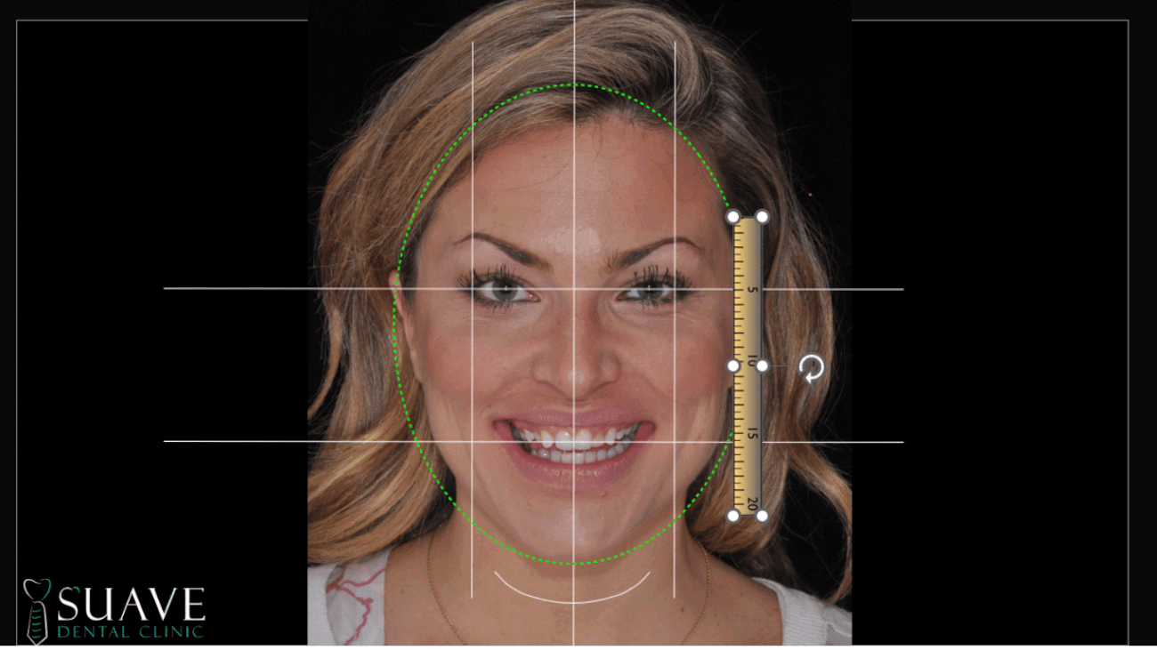 Digital Smile Design For a Perfect Smile Makeover