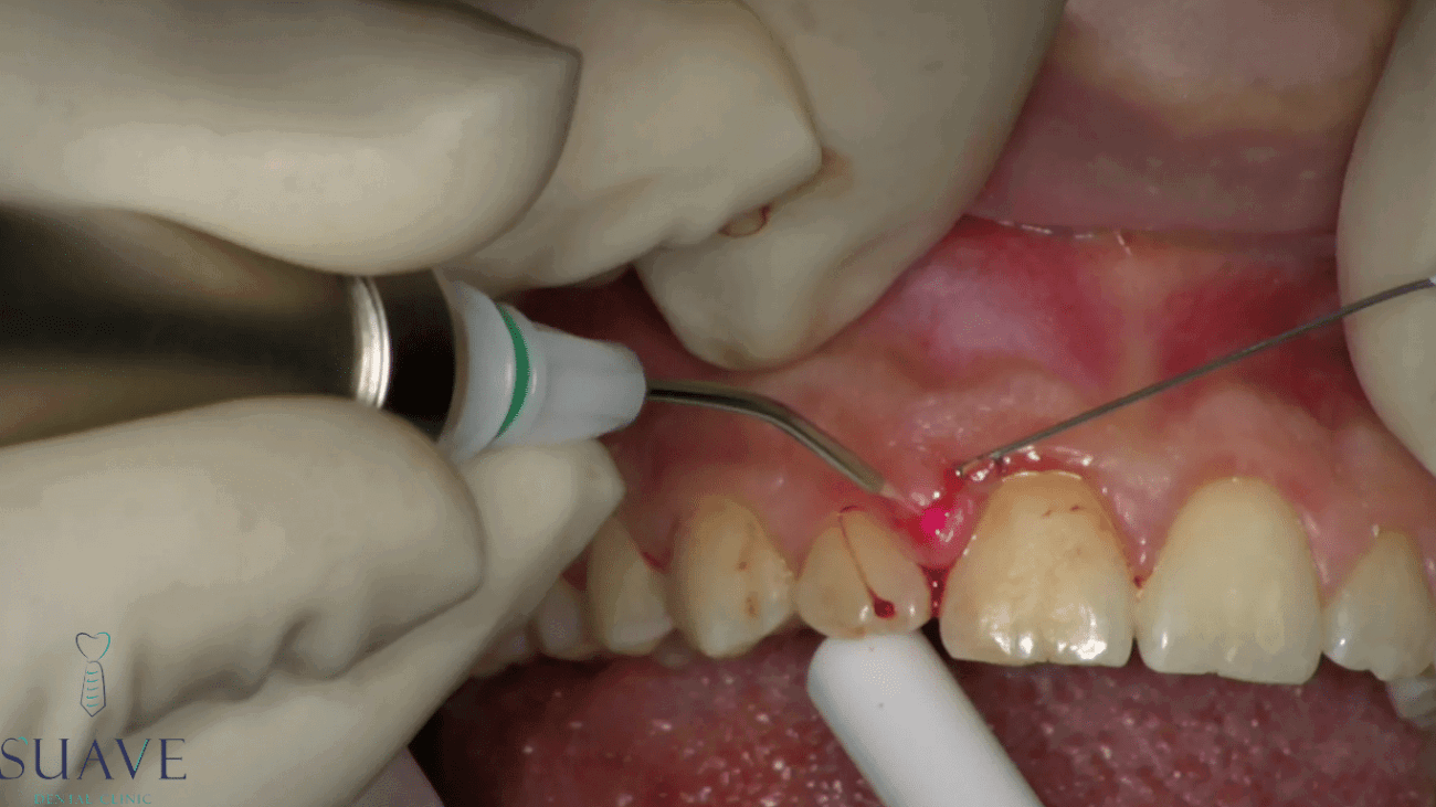 Gingivectomy and Gingivoplasty in Turkey - Suave Clinic