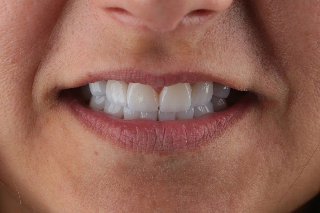 Natural Hollywood Smile - Suave Dental Clinic